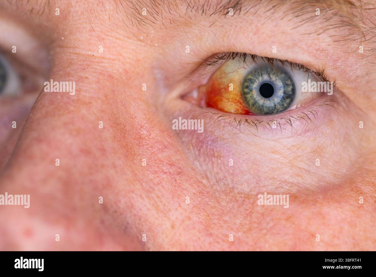Damaged vein in the eye. Blood in the human eye. Closeup made with ...