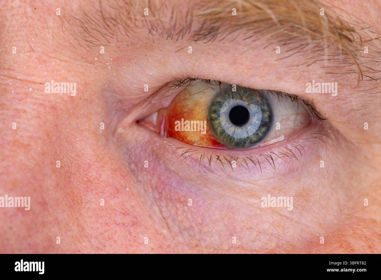 Damaged vein in the eye. Blood in the human eye. Closeup made with ...