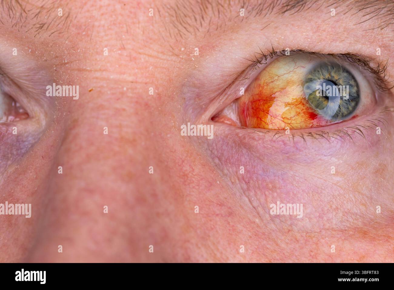Damaged vein in the eye. Blood in the human eye. Closeup made with ...