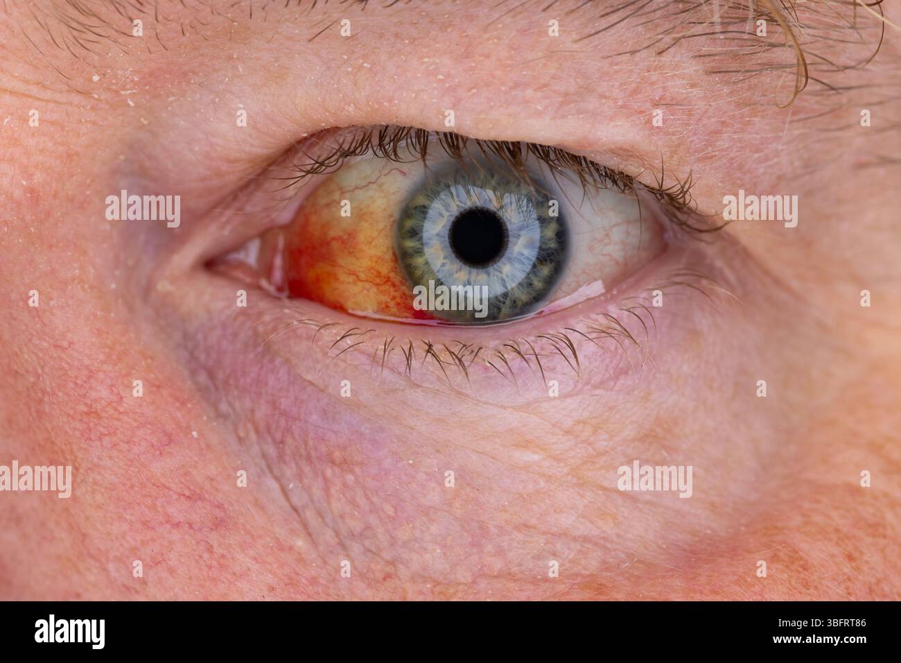 Damaged vein in the eye. Blood in the human eye. Closeup made with ...