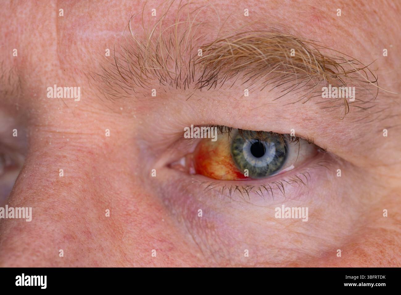 Damaged vein in the eye. Blood in the human eye. Closeup made with ...