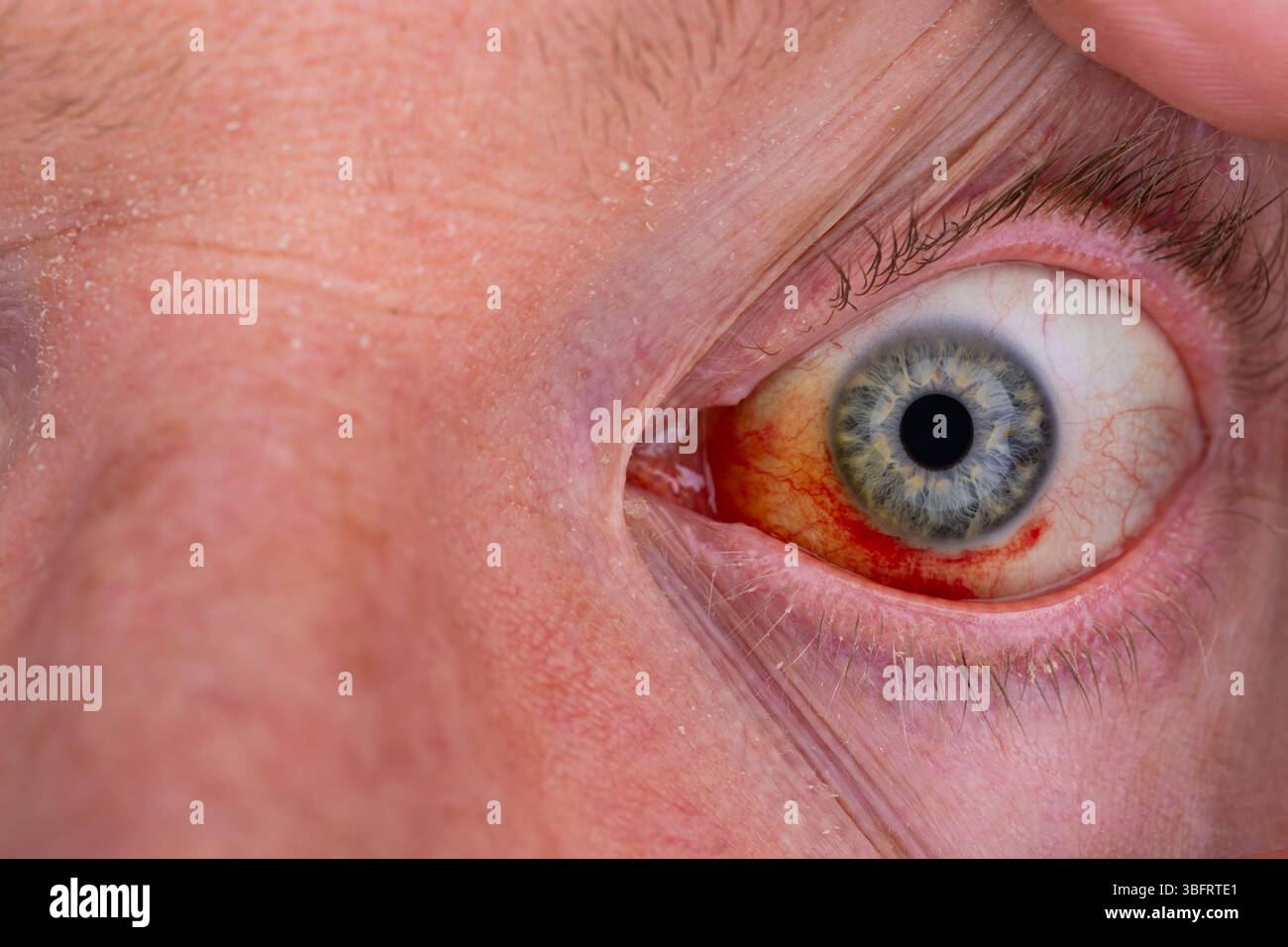 Damaged vein in the eye. Blood in the human eye. Closeup made with ...