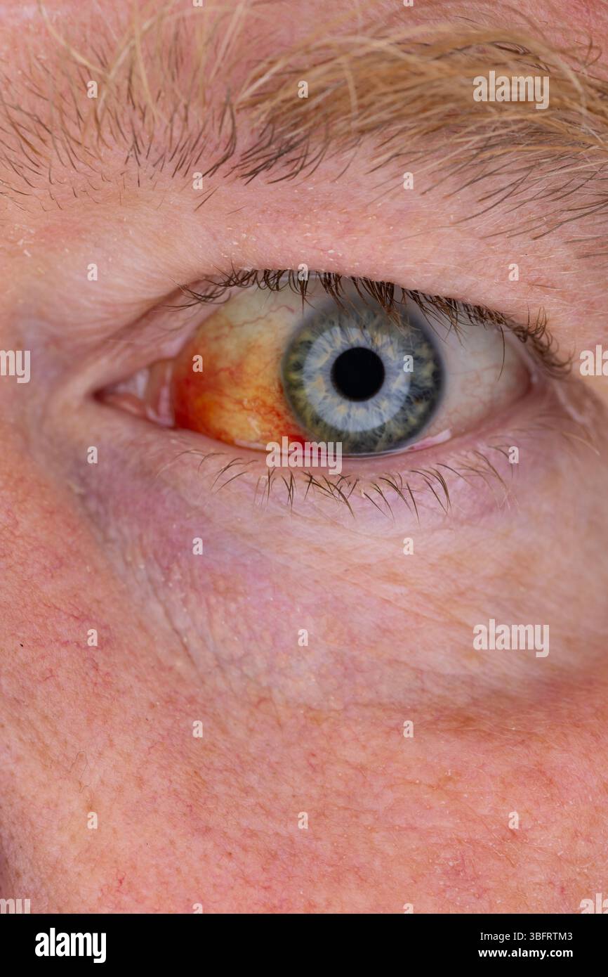 Damaged vein in the eye. Blood in the human eye. Closeup made with ...