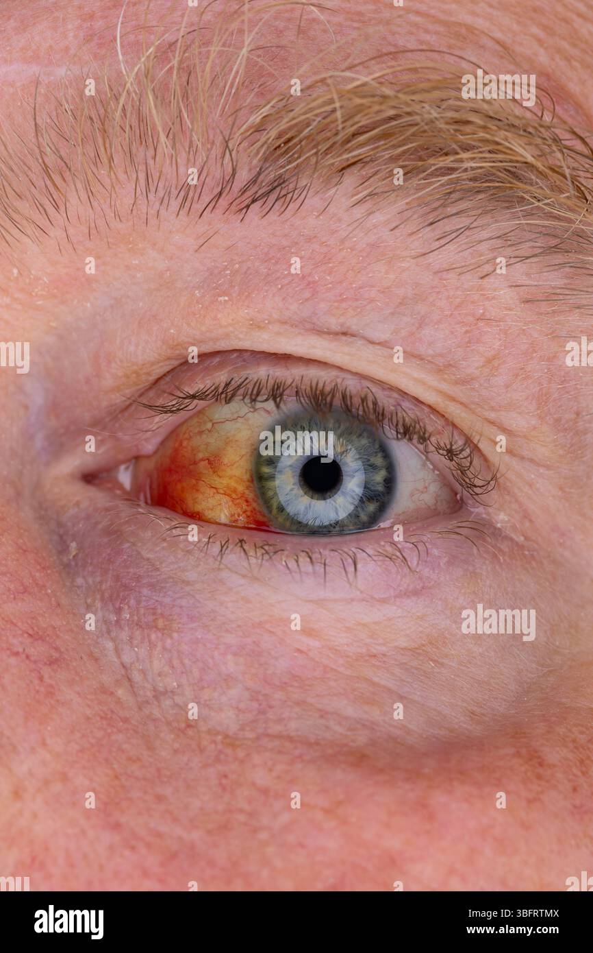 Damaged vein in the eye. Blood in the human eye. Closeup made with ...