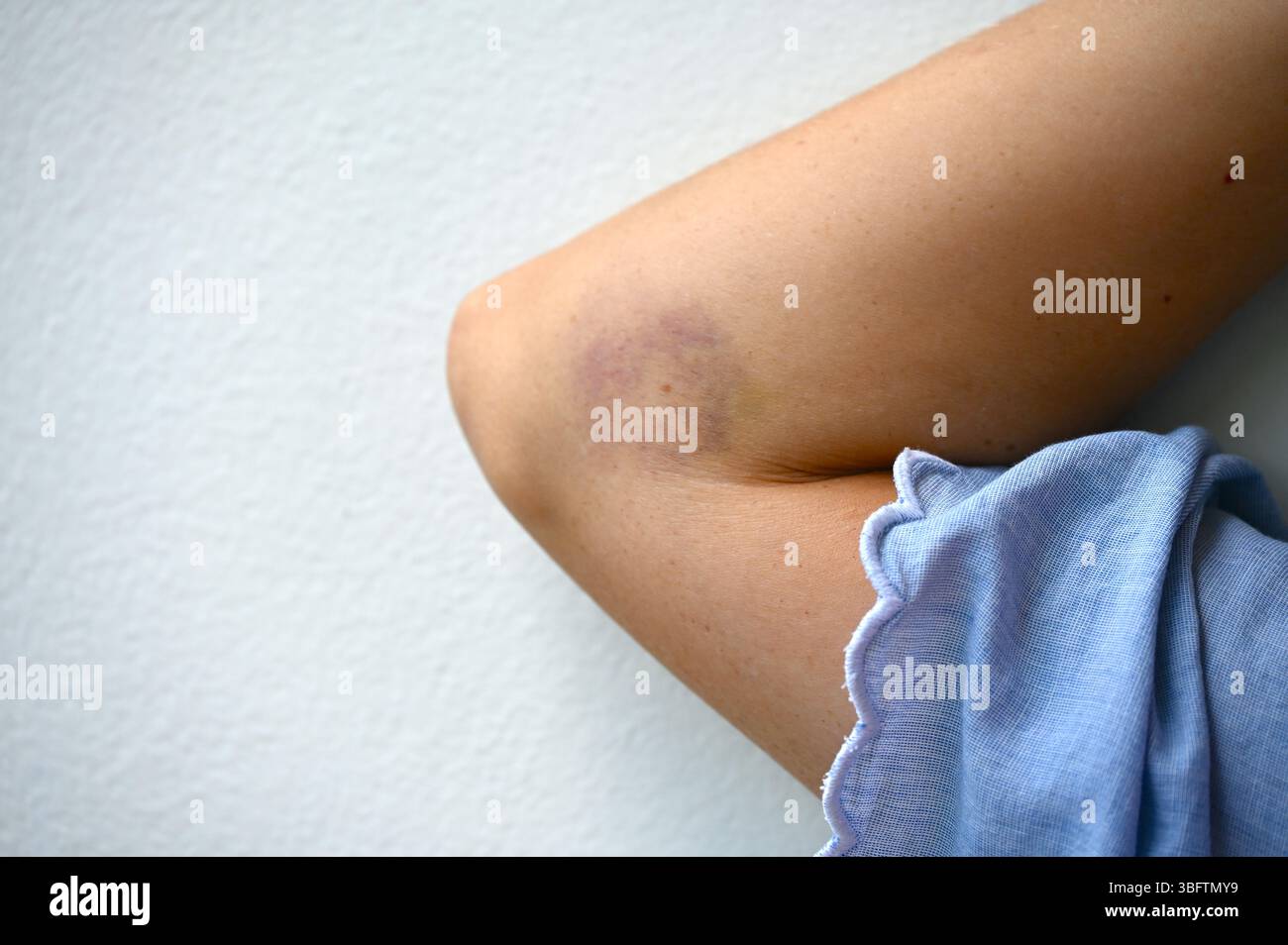 Huge bruise on female hand around elbow in result of falling on ...