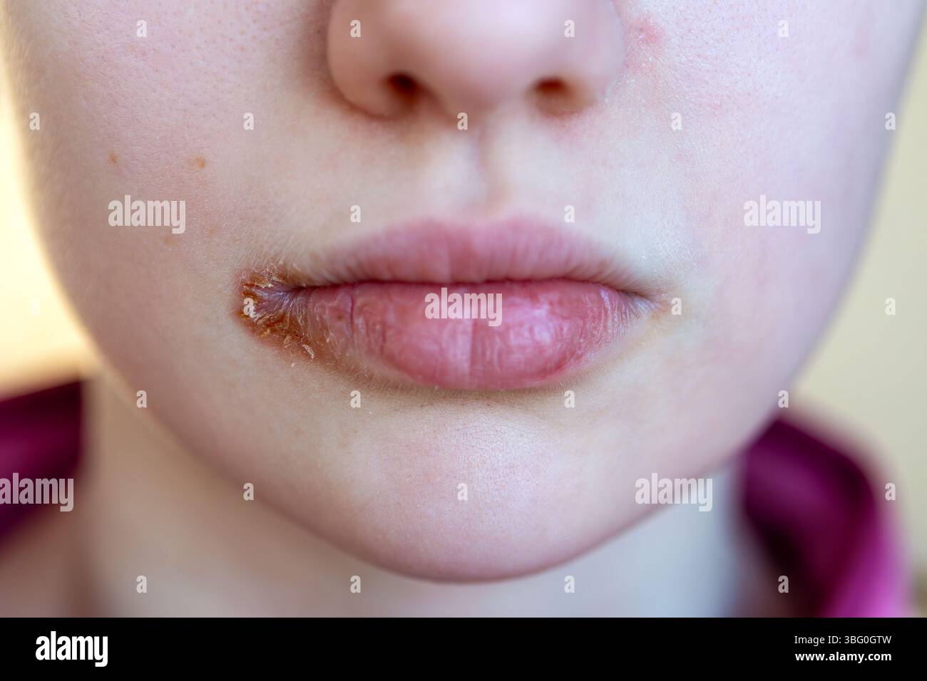 Close-up of lips with herpes infection. Macro shot of a person's lips ...