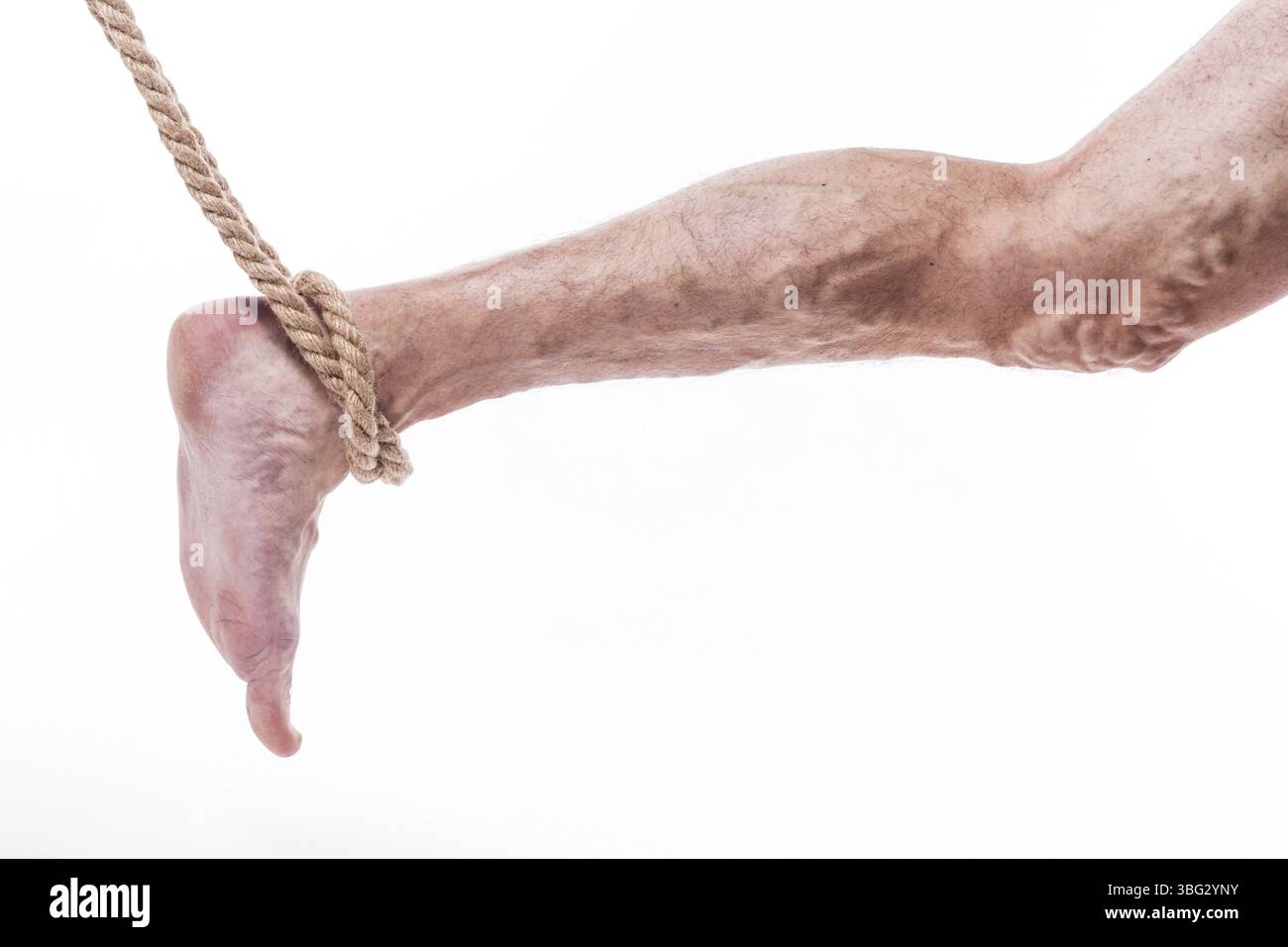 Human leg with blocked veins, thrombosis, phlebitis, and standing on a ...