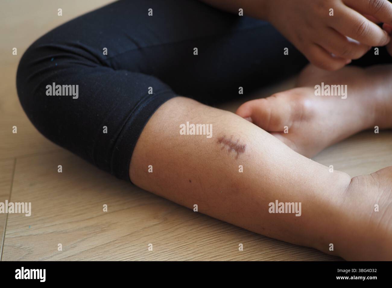 Child showing a healing scar on their leg while sitting Stock Photo - Alamy