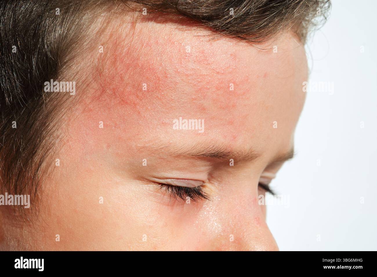 Chicken pox rash spots on child skin close-up. Coxsackie virus on boy ...