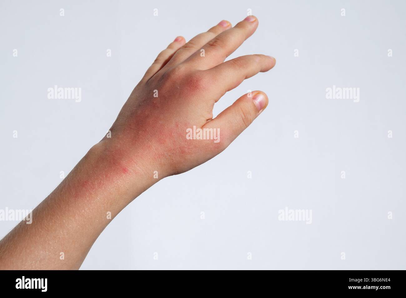 Chicken pox red rash spots on child skin close-up. Coxsackie virus on ...
