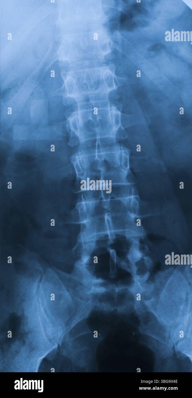 Frontal X-ray of the pelvic spine Stock Photo - Alamy