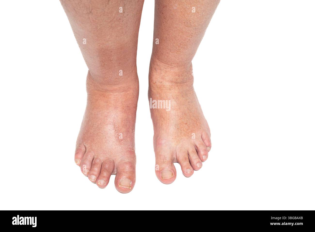 Swollen leg caused by a broken toe. Unrecognizable man with swollen ...
