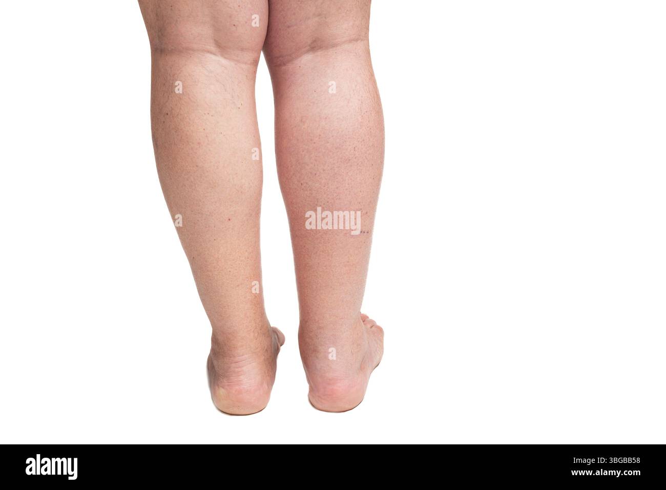 Swollen leg caused by a broken toe. Unrecognizable man with swollen ...