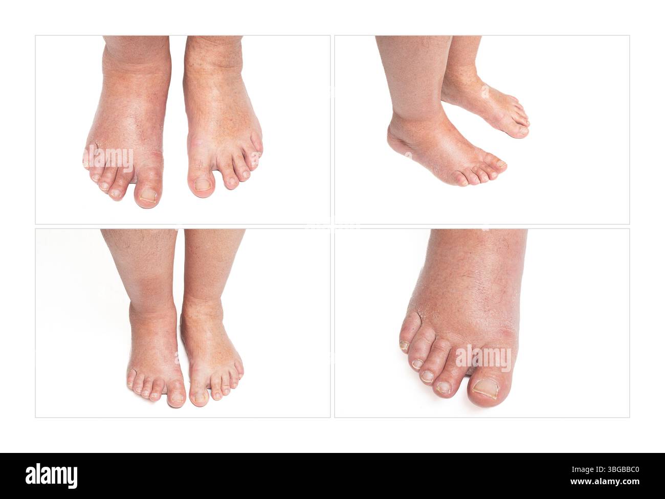 Collage of swollen legs caused by a broken toe. Unrecognizable man with ...