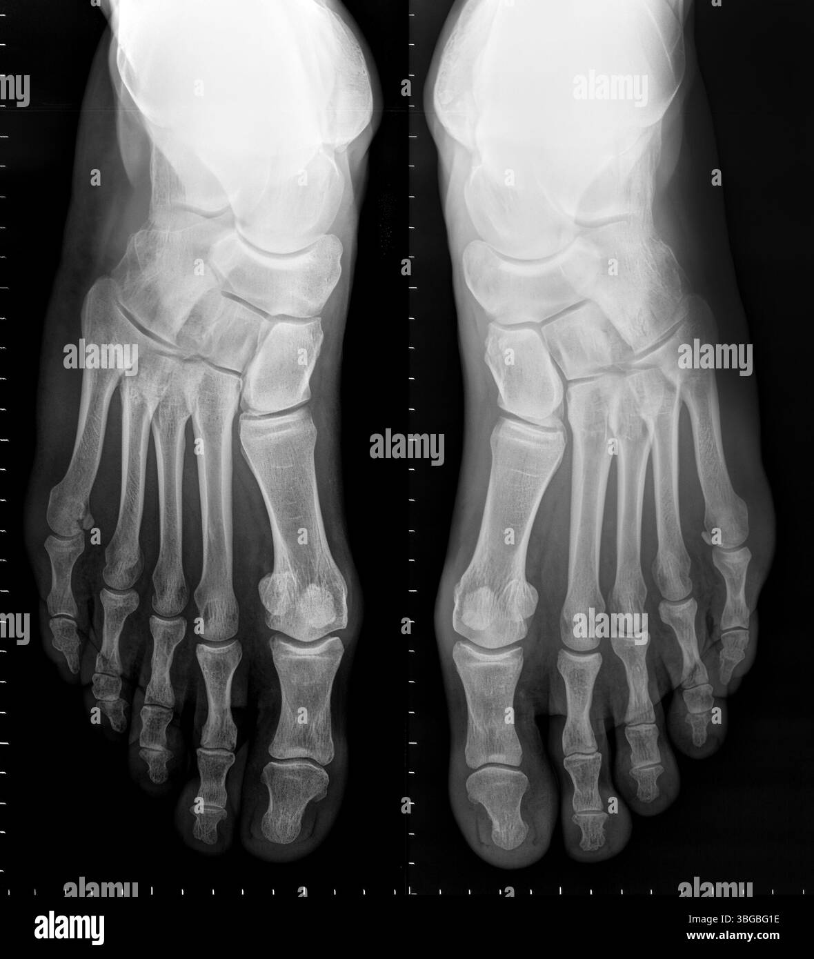 Radiography showing normal foot anatomy, including bones, joints, and ...