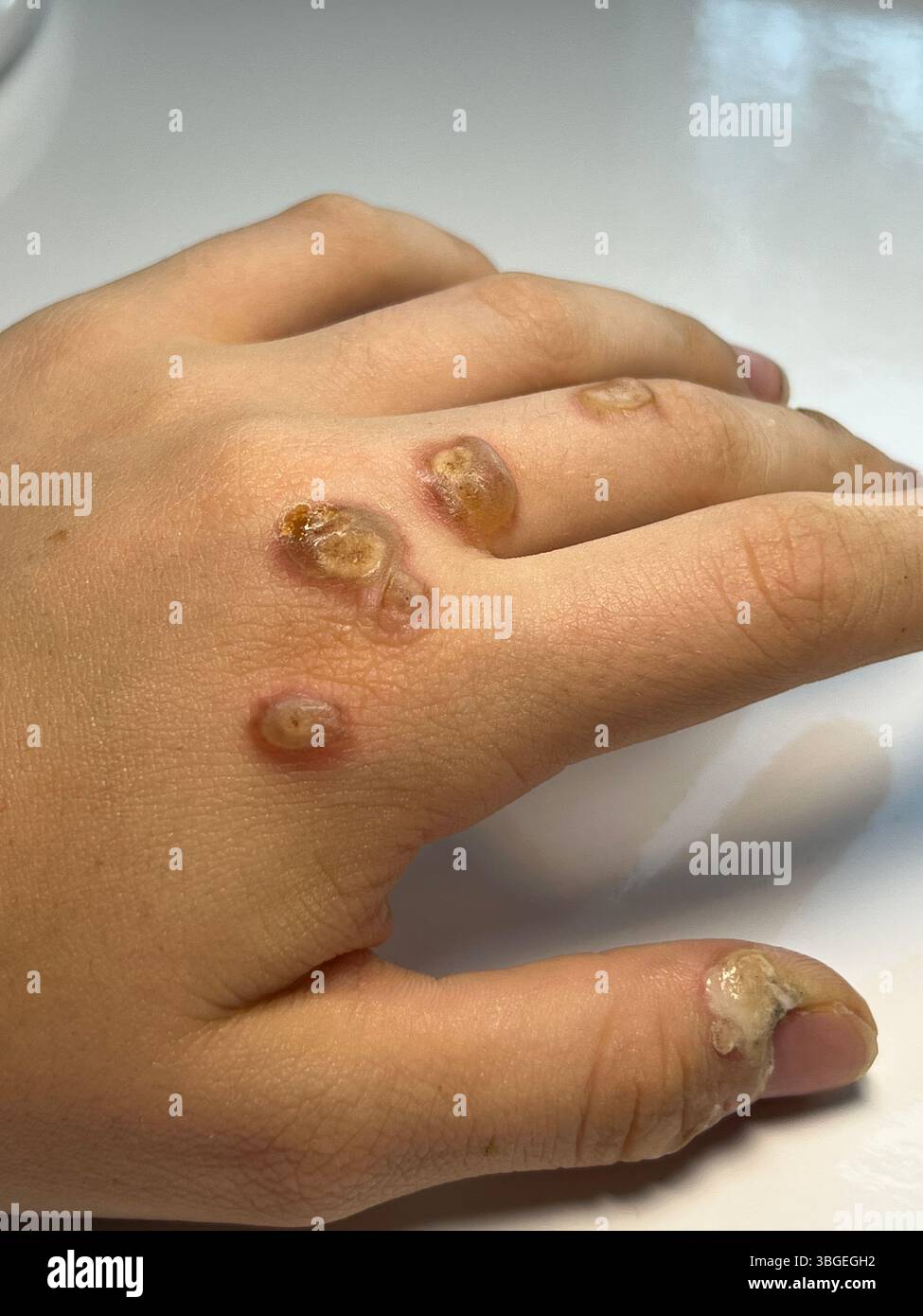 Hand with many scars after wart removal by chemical freezing. Damage to ...