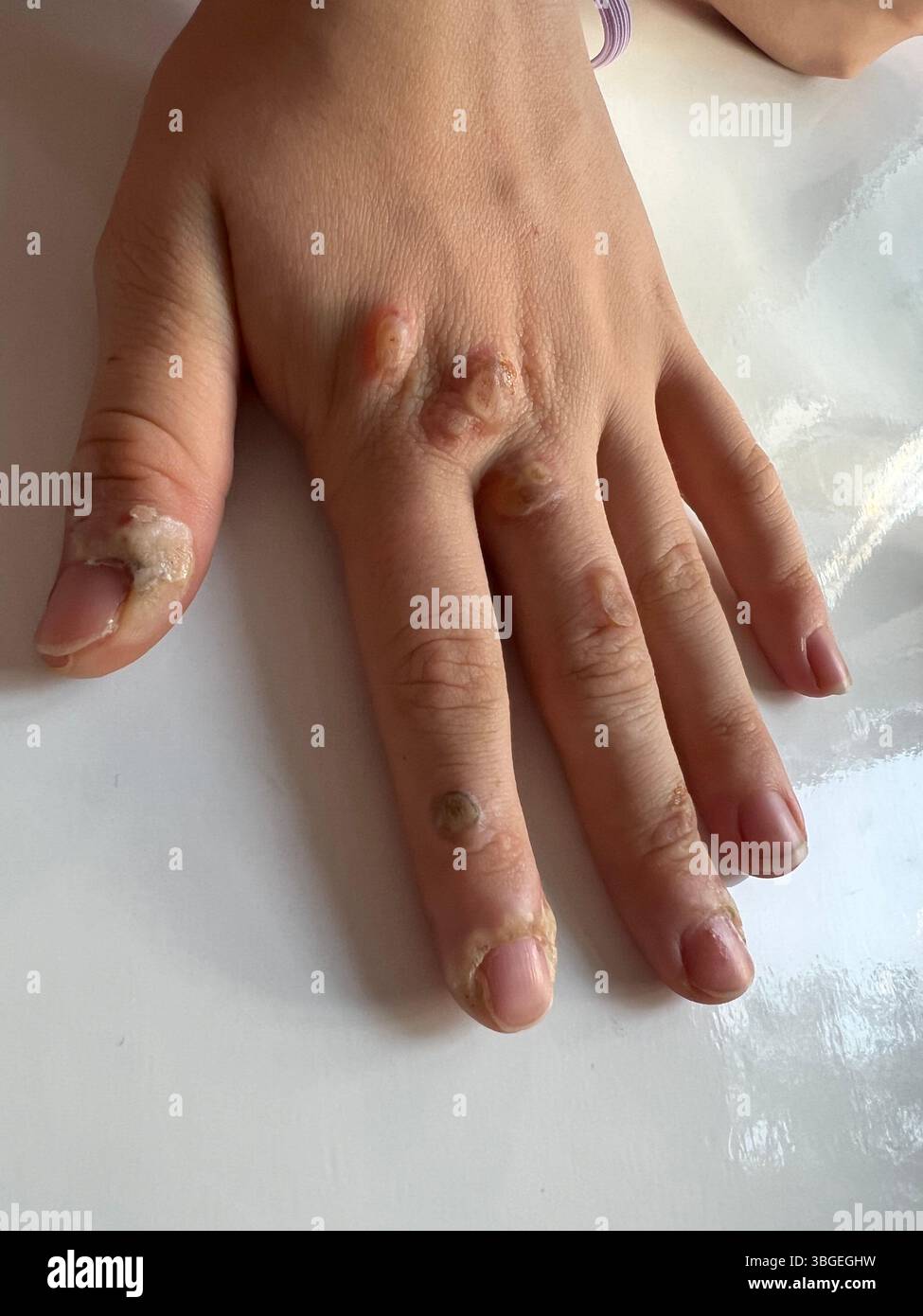 Hand with many scars after wart removal by chemical freezing. Damage to ...