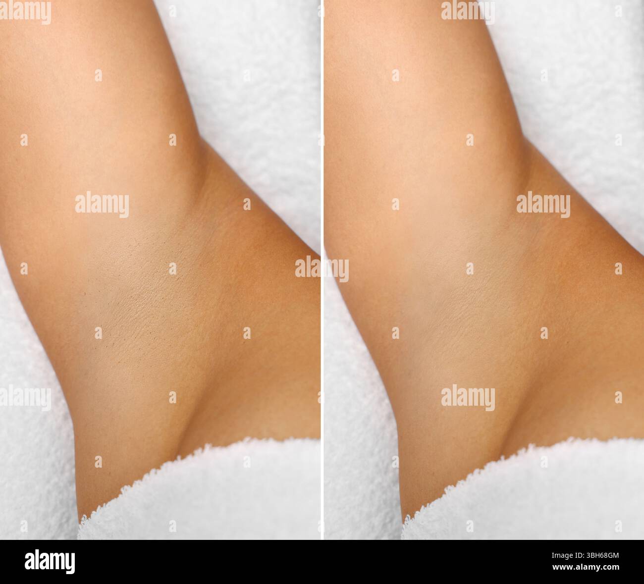Epilation and depilation. Collage with photos of woman showing armpit ...