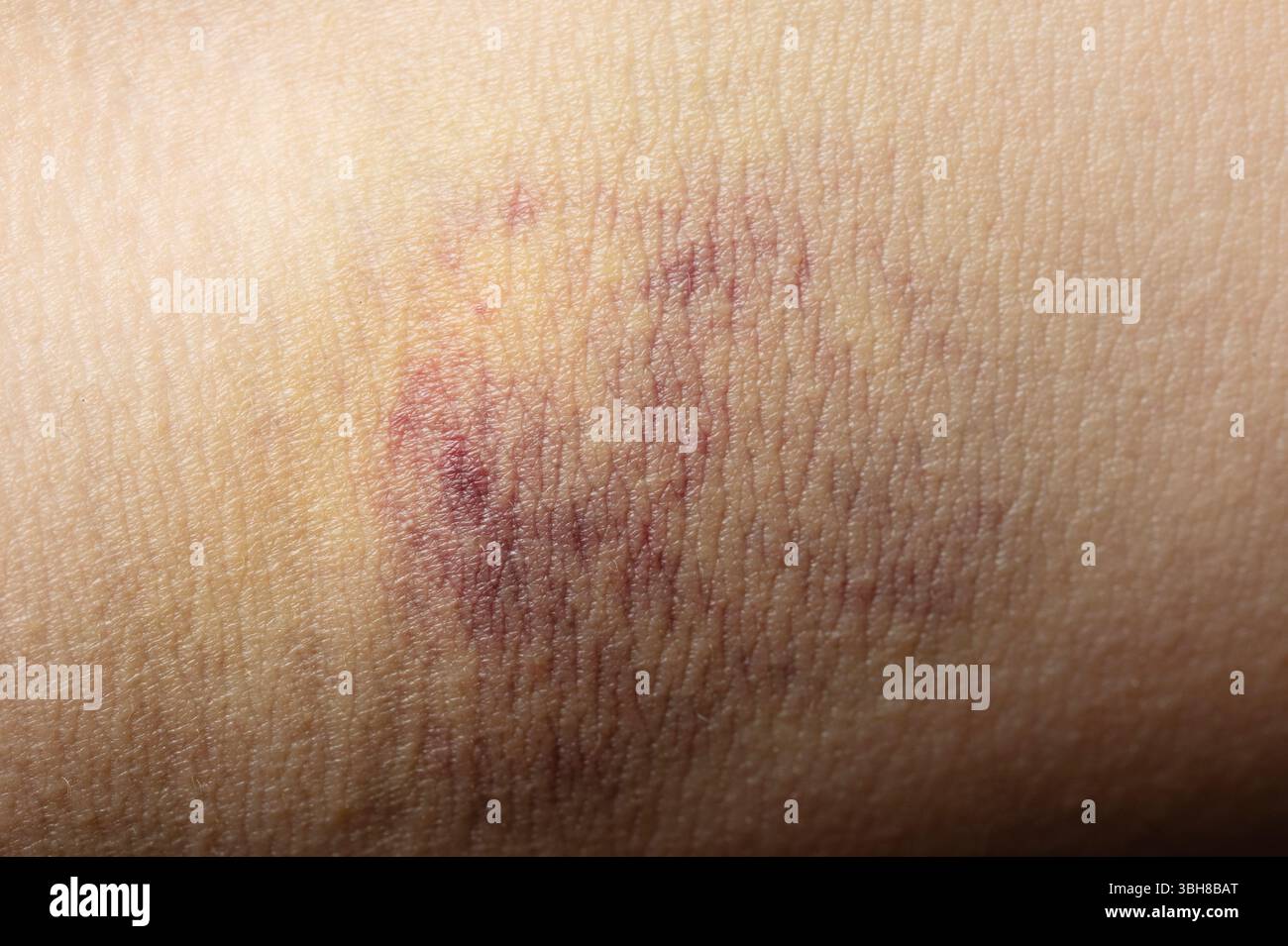 Red bruise on human skin macro close up view Stock Photo - Alamy