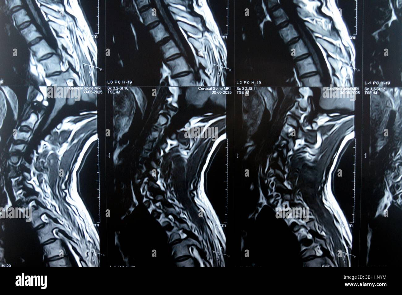 MRI of cervical spine reveals Spondylodegenerative changes along the ...