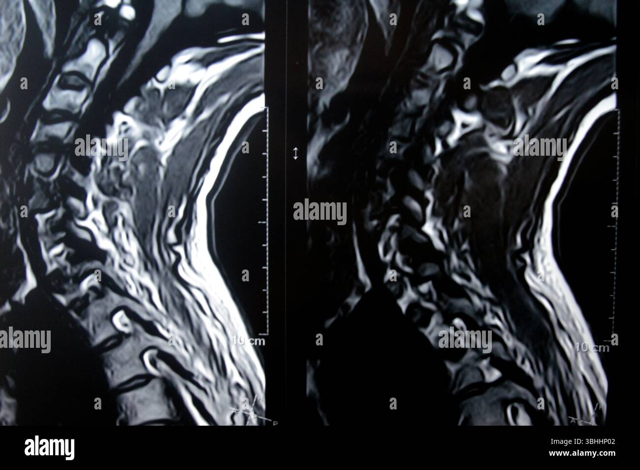 MRI of cervical spine reveals Spondylodegenerative changes along the ...