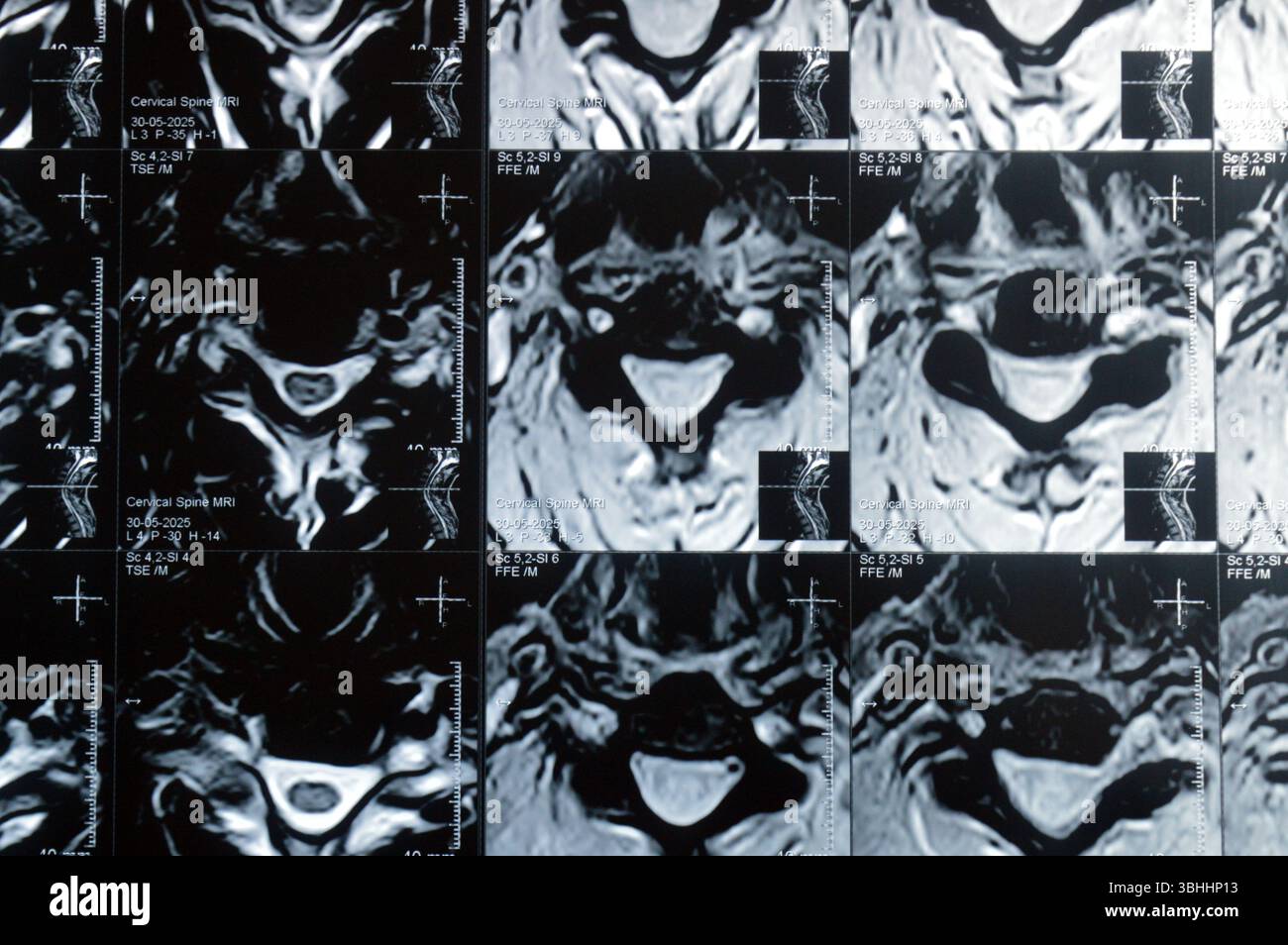 MRI of cervical spine reveals Spondylodegenerative changes along the ...