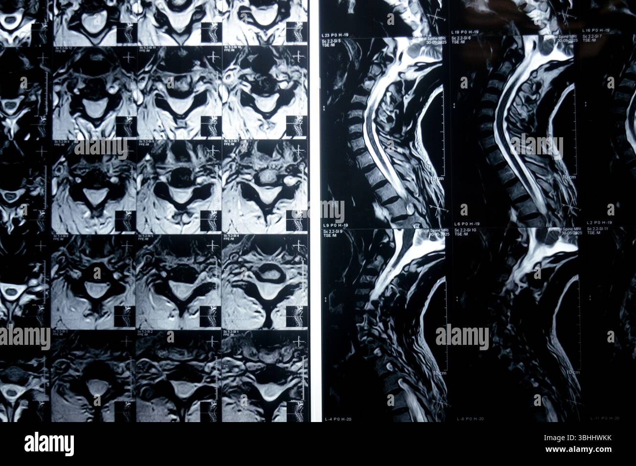 MRI of cervical spine reveals Spondylodegenerative changes along the ...