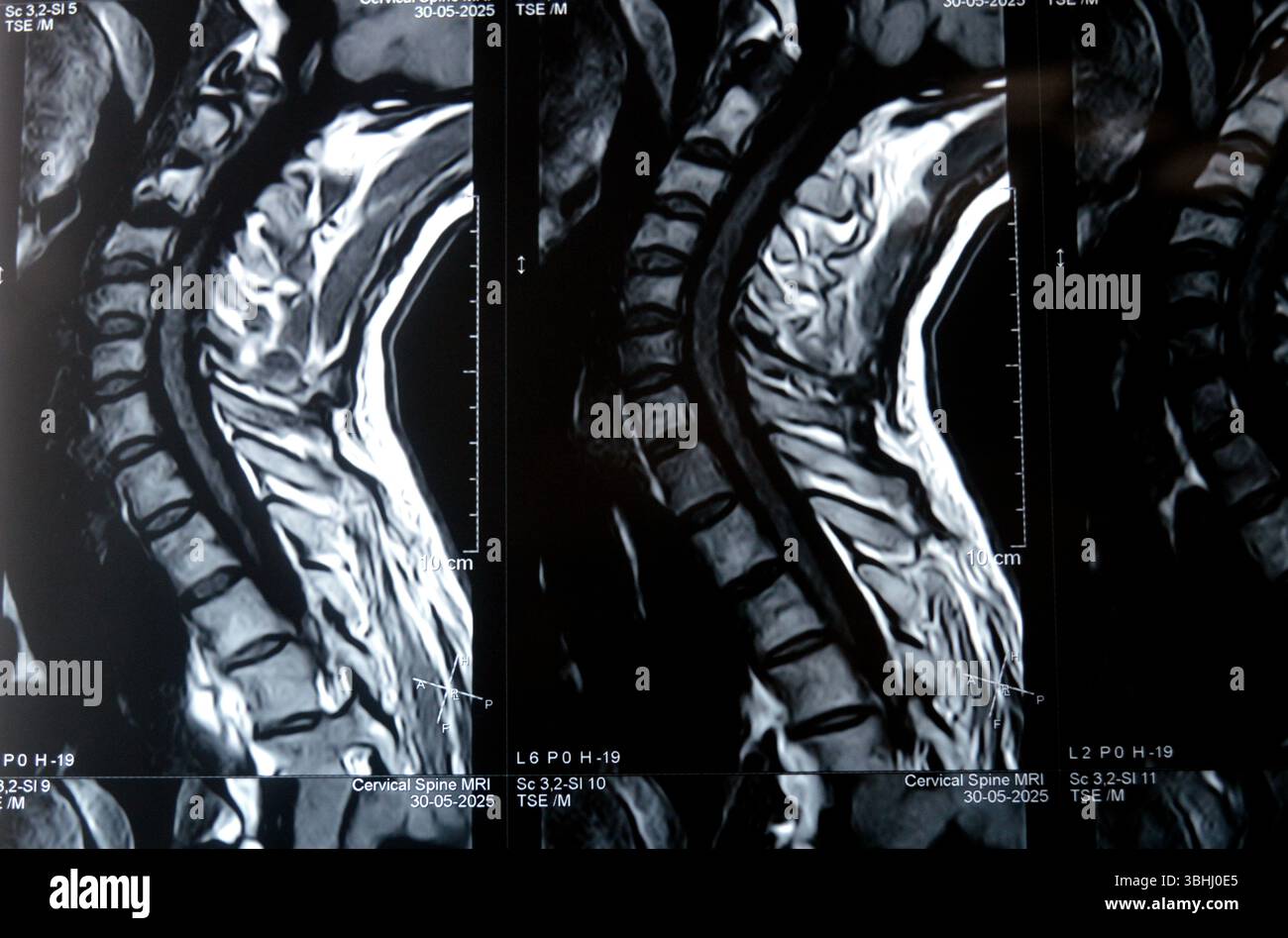 MRI of cervical spine reveals Spondylodegenerative changes along the ...