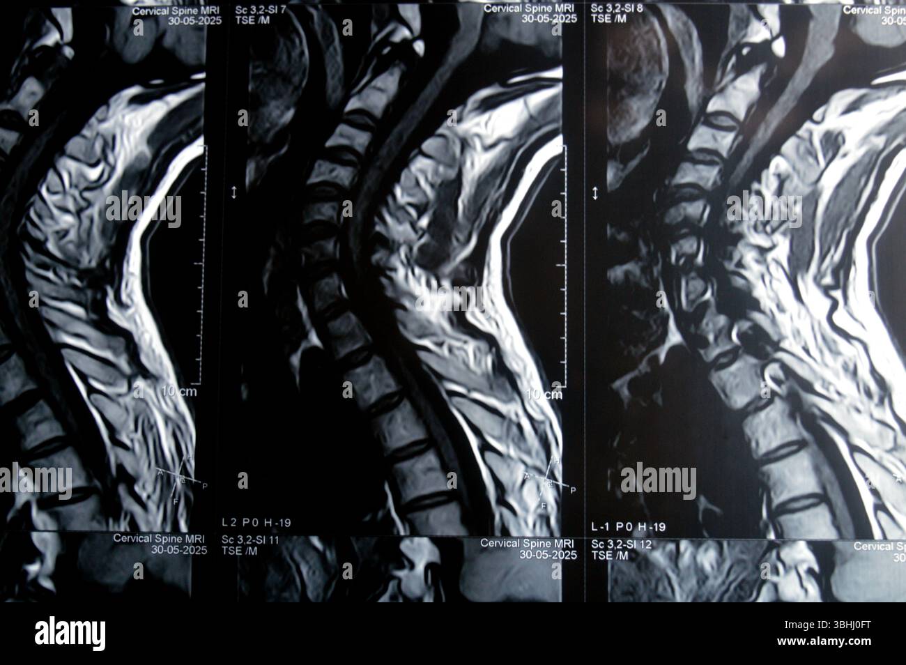 MRI of cervical spine reveals Spondylodegenerative changes along the ...