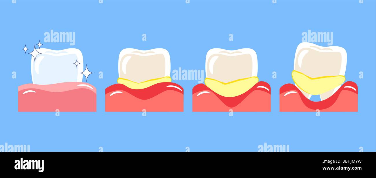 Periodontal disease . Included gingivitis, dental calculus, gum ...