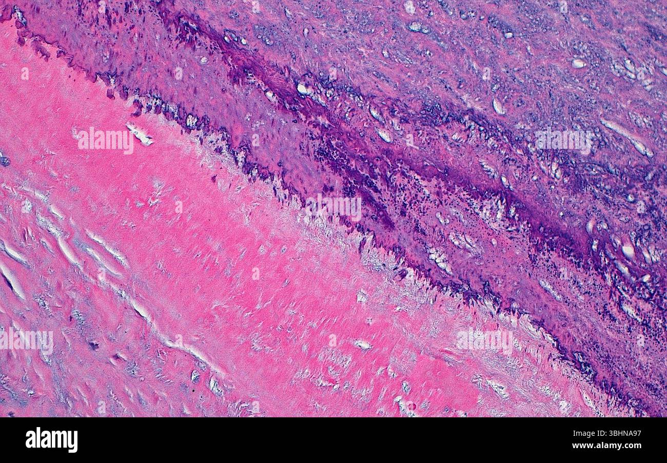 Light micrograph of calcification in a vessel wall. The calcified ...