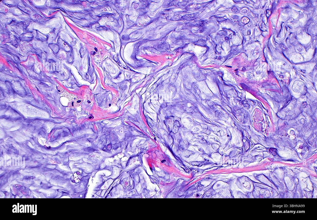 Light micrograph of acellular mucin. This image shows mucin substance ...