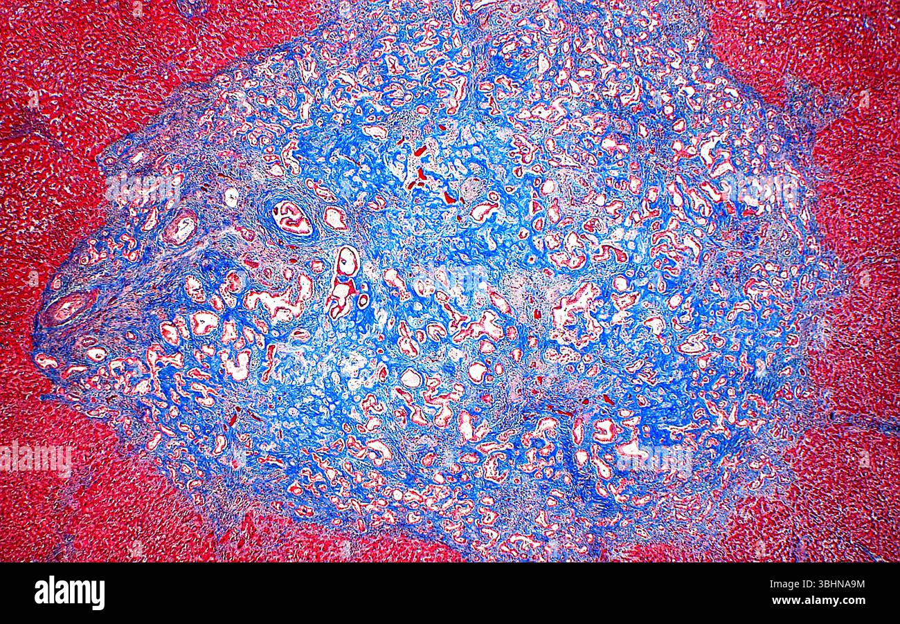 Light micrograph of a bile duct adenoma. A bile duct adenoma is a ...