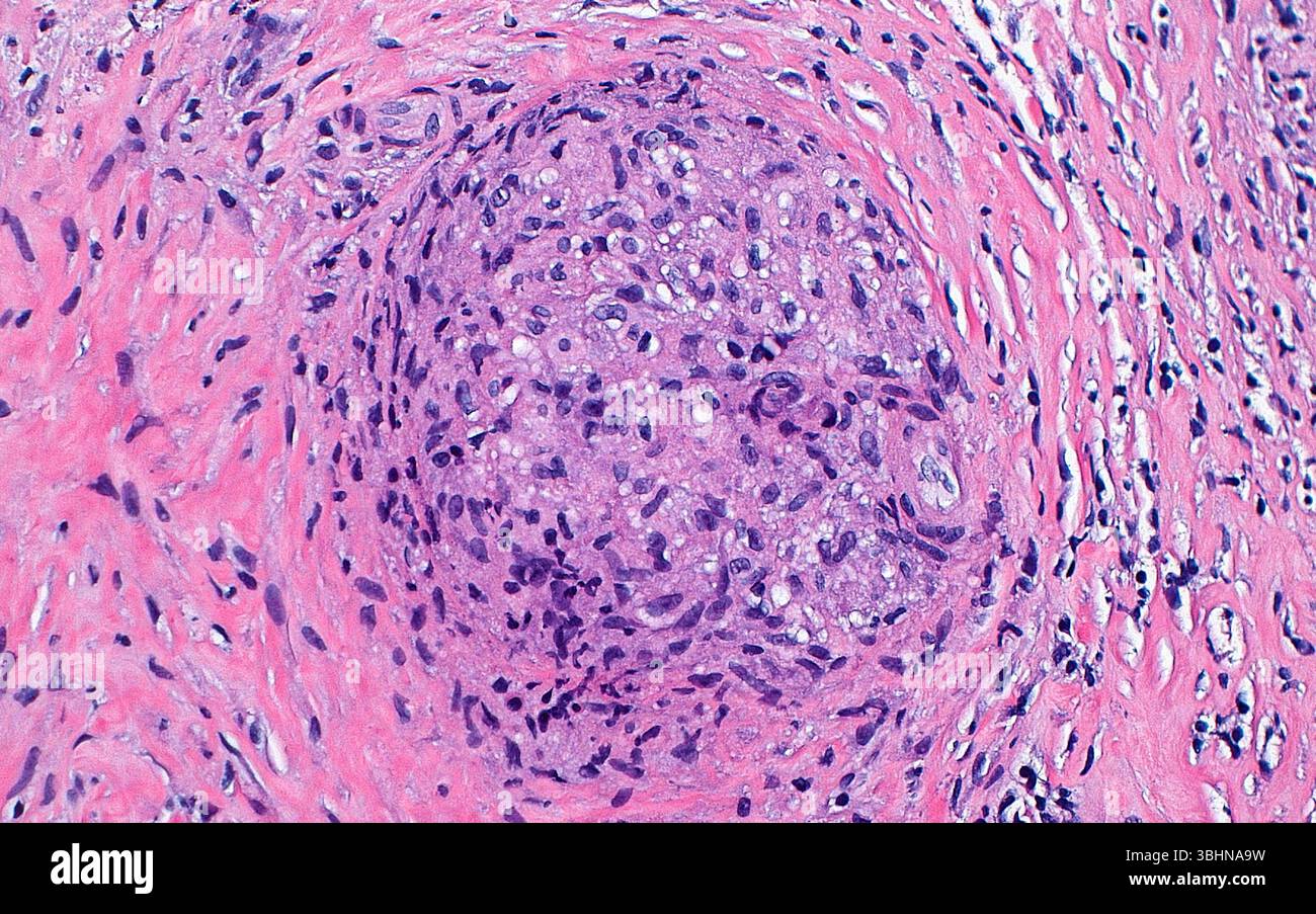 Light micrograph of a granuloma. A granuloma is a structure that forms ...