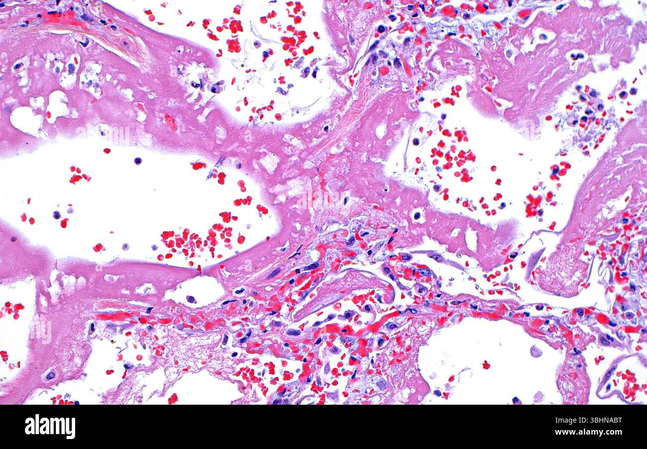 Light micrograph of diffuse alveolar lung damage. Diffuse alveolar ...