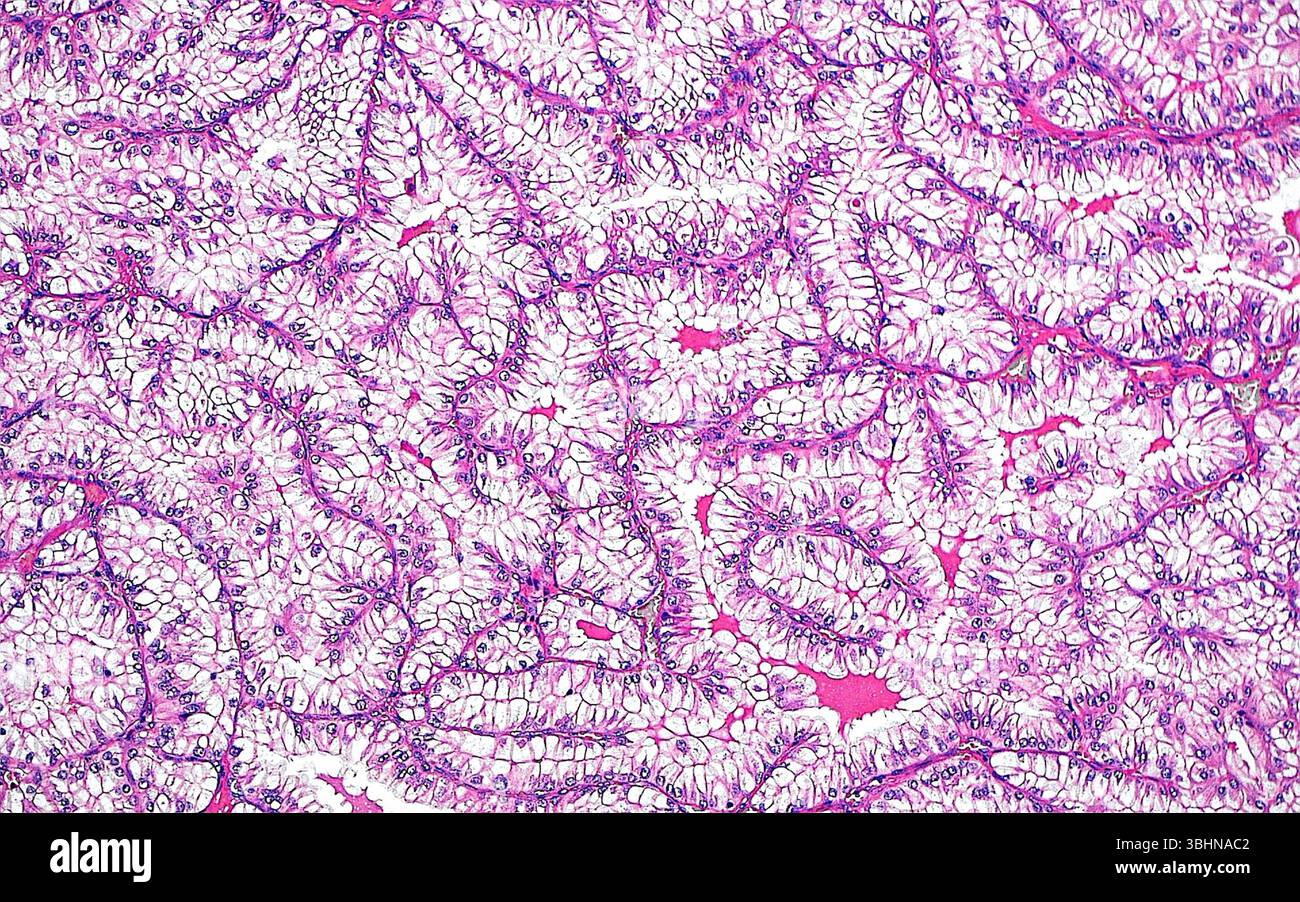 Light micrograph of renal cell carcinoma with fibromyomatous stroma ...
