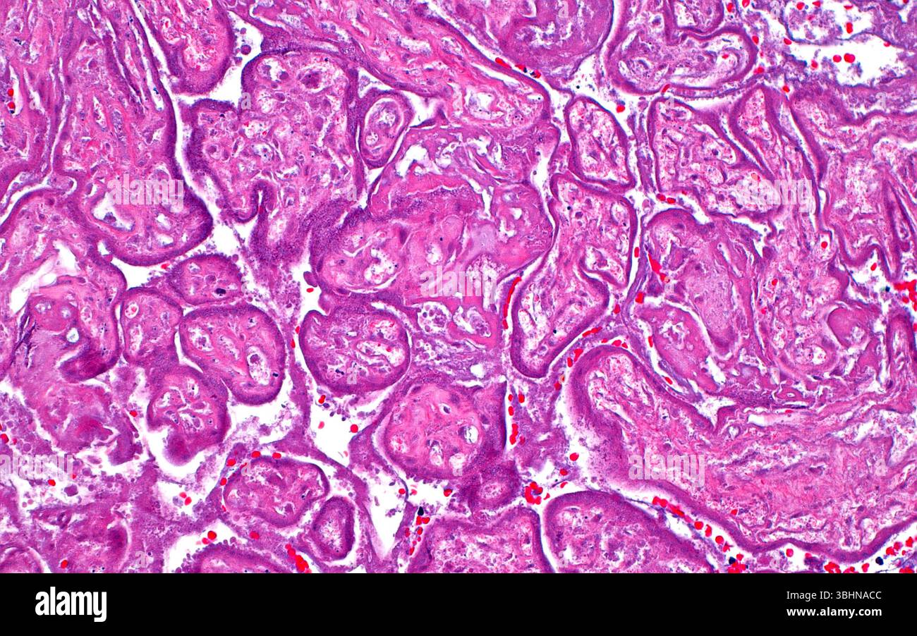 Light micrograph of infarcted placental villi. Infarcts in the placenta ...