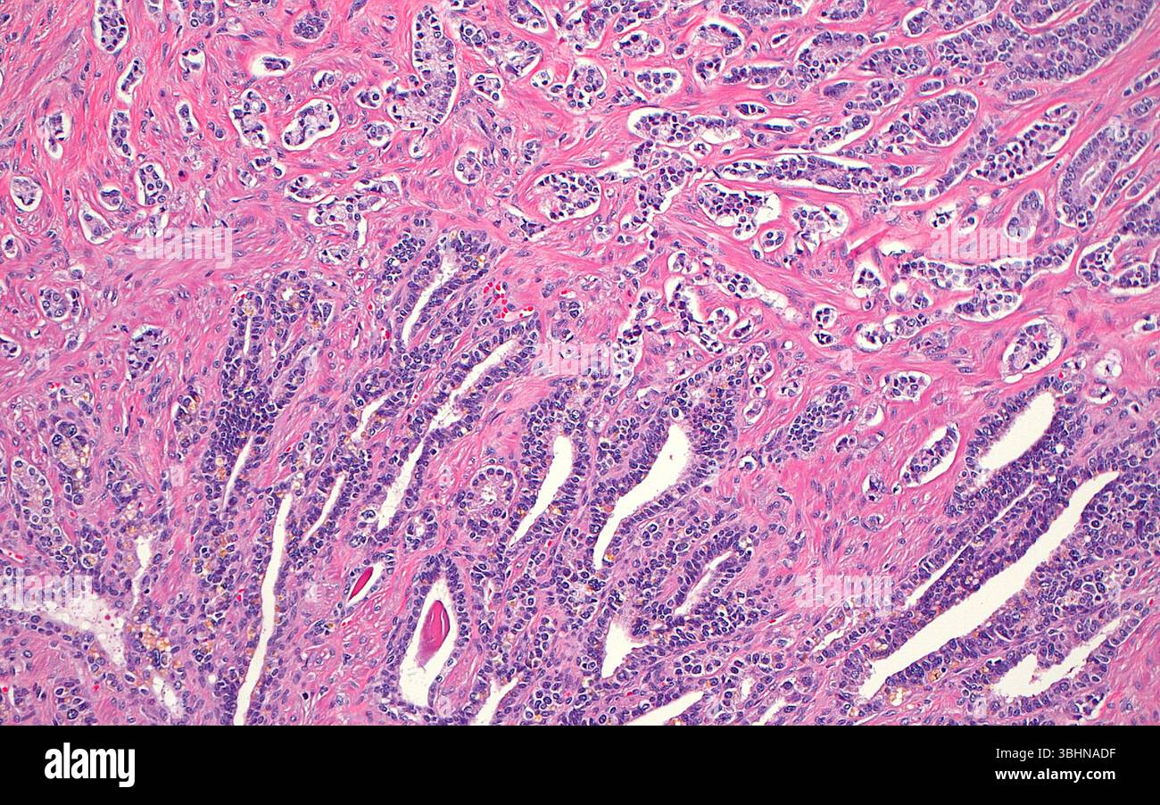 Light micrograph of seminal vesicle invasion by prostate cancer ...