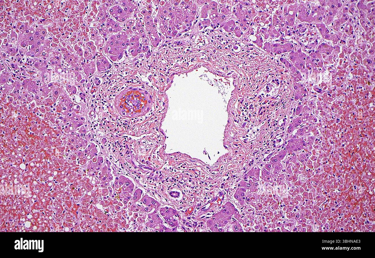Light micrograph of liver centrilobular (zone 3) necrosis. When blood ...