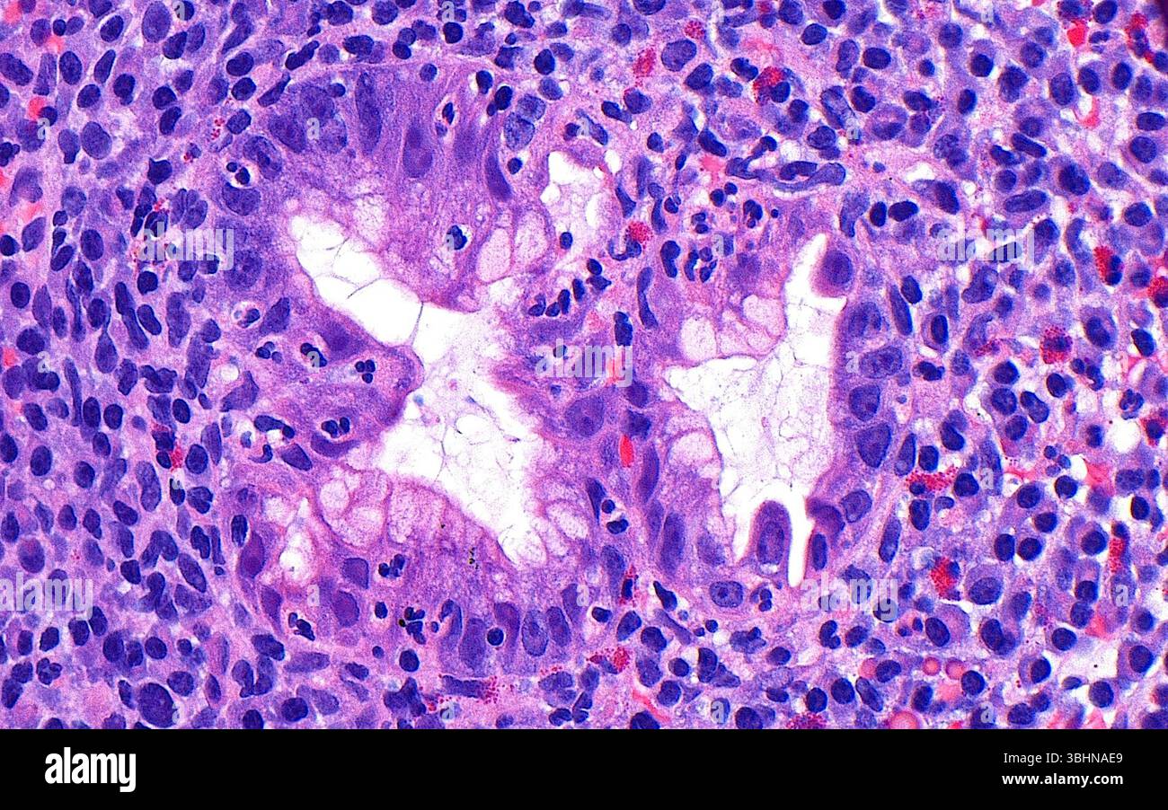 Light micrograph of chronic active gastritis. Gastritis is inflammation ...