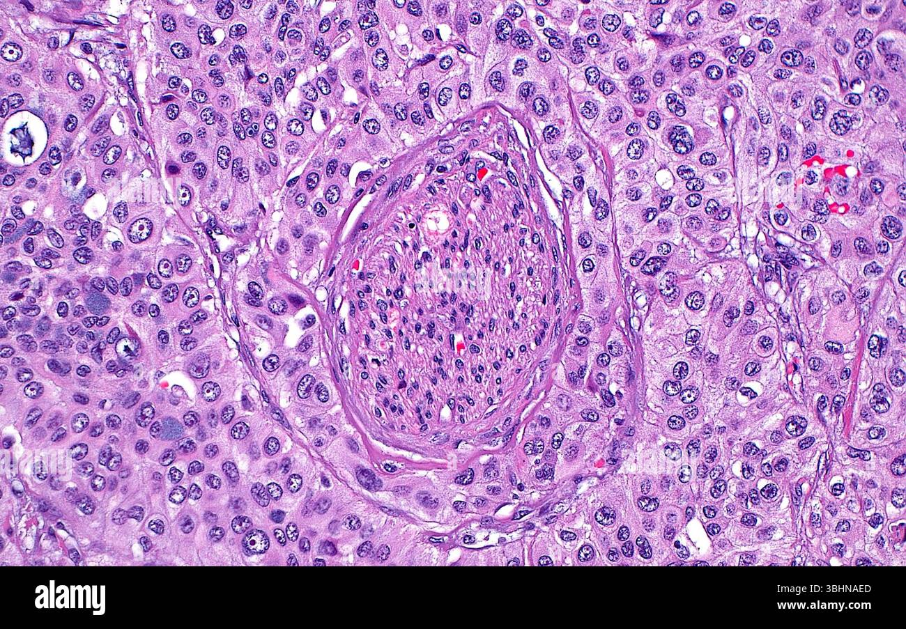 Light micrograph of perineural invasion by pancreatic adenocarcinoma. A ...