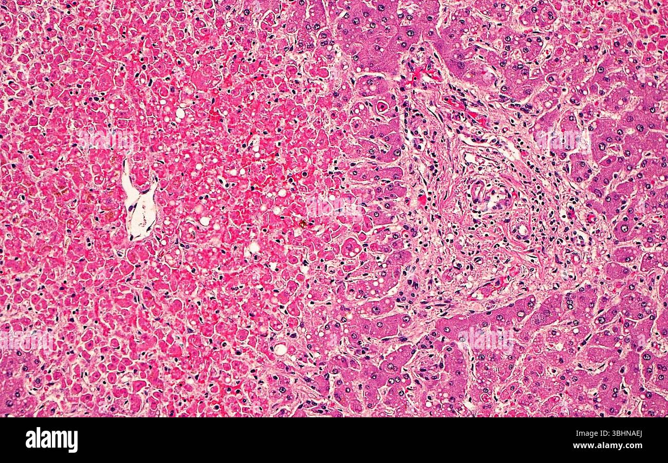 Light micrograph of liver centrilobular (zone 3) necrosis. When blood ...