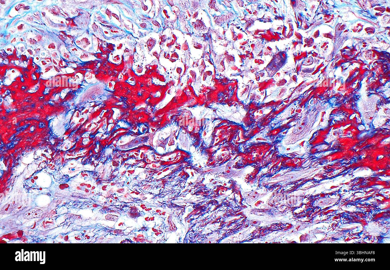 Light micrograph of fibrinoid necrosis in a blood vessel. Fibrinoid ...