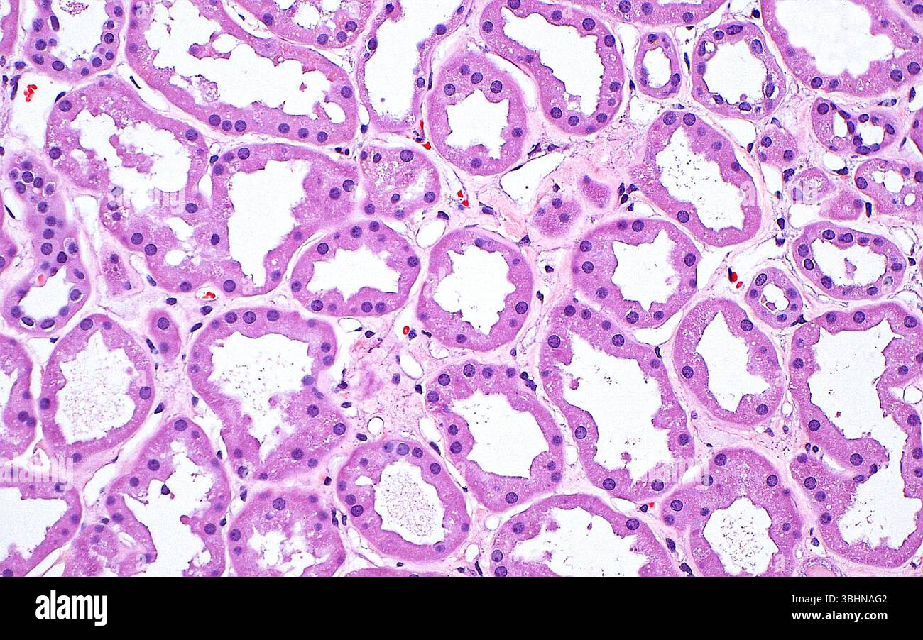 Light micrograph of kidney with acute tubular injury. Tubular injury is ...