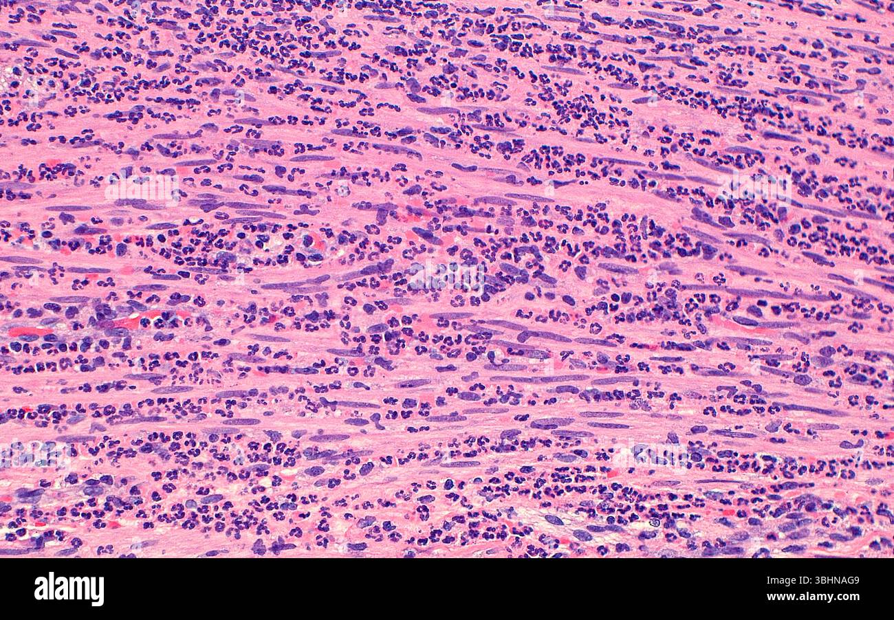 Light micrograph of acute appendicitis. Numerous neutrophils (small ...