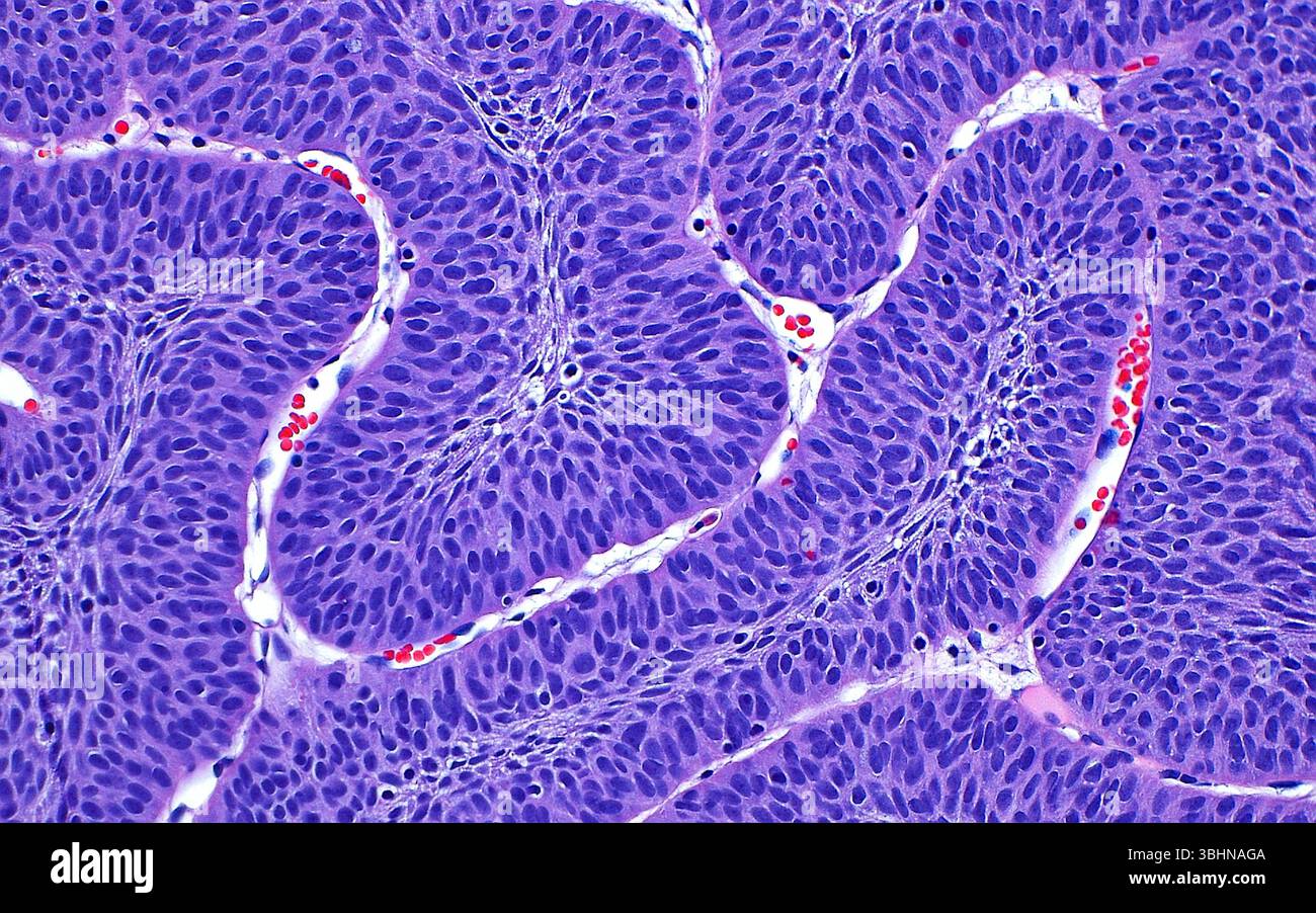Light micrograph of an inverted urothelial papilloma. An inverted ...
