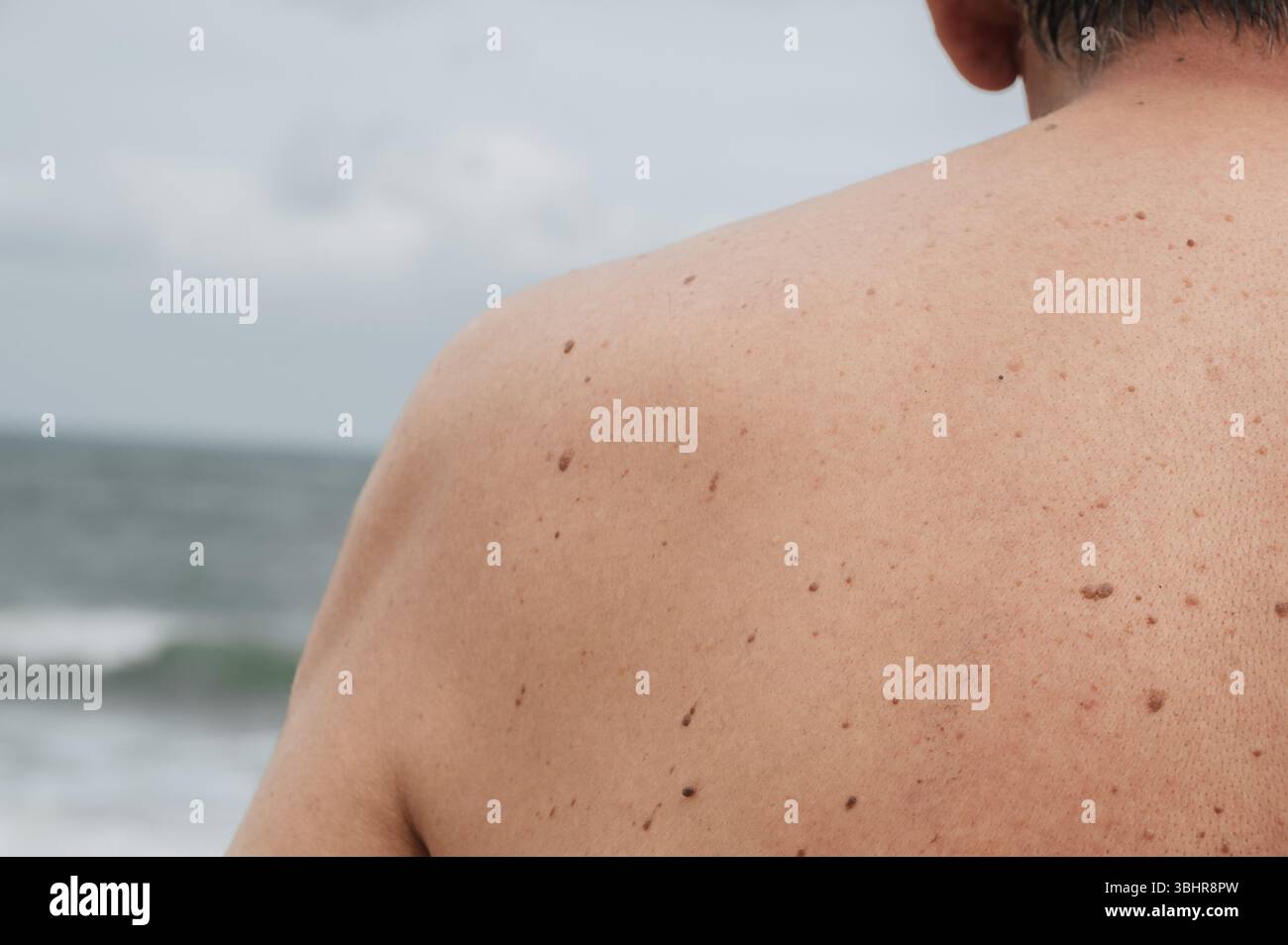 The back of an elderly man with freckles, aging spots, black, brown ...