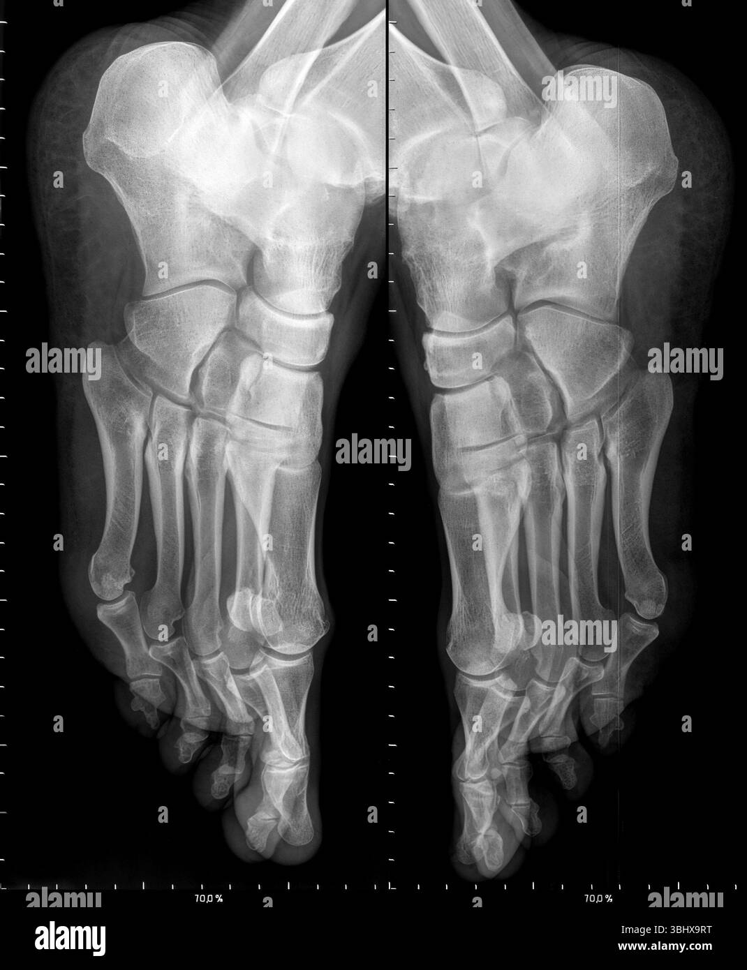 X-ray showing human foot bones and joints. Top 45 degrees view Stock ...