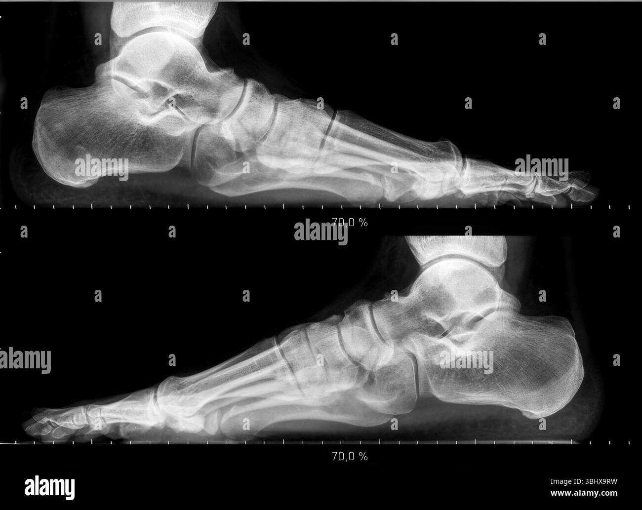 X-ray showing healthy human foot bones and joints. Both sides view ...
