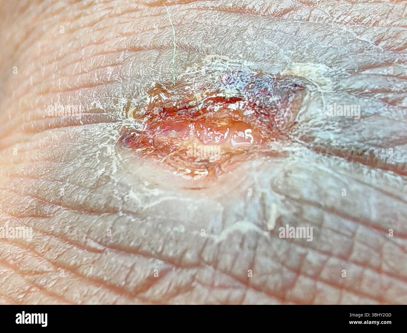 Close-Up of Skin Lesion with Wound and Scab Formation Stock Photo - Alamy